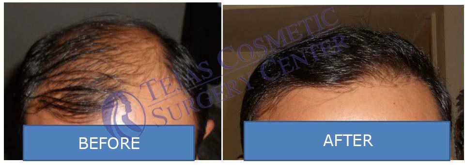 Cosmetic Surgery For Men - Gynecomastia, Hair Transplant, Liposuction